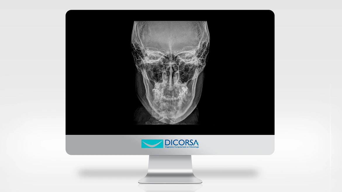 Radiografía De Los Senos Paranasales
